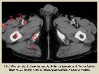 Presentation1.pptx, ct normal anatomy of the abdomen and pelvis. | PPTX