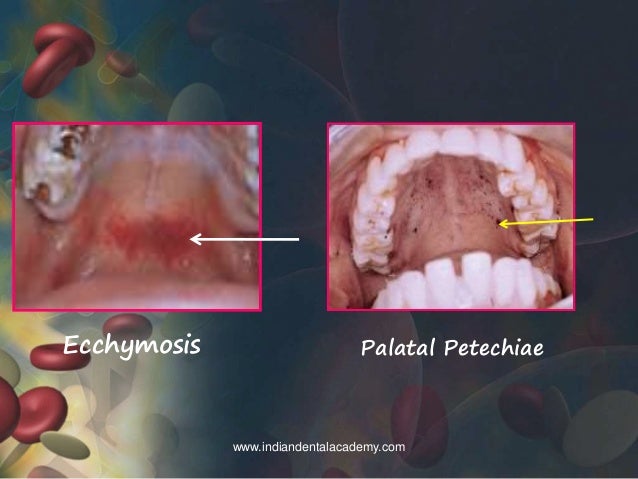 leukemia / dental implant courses