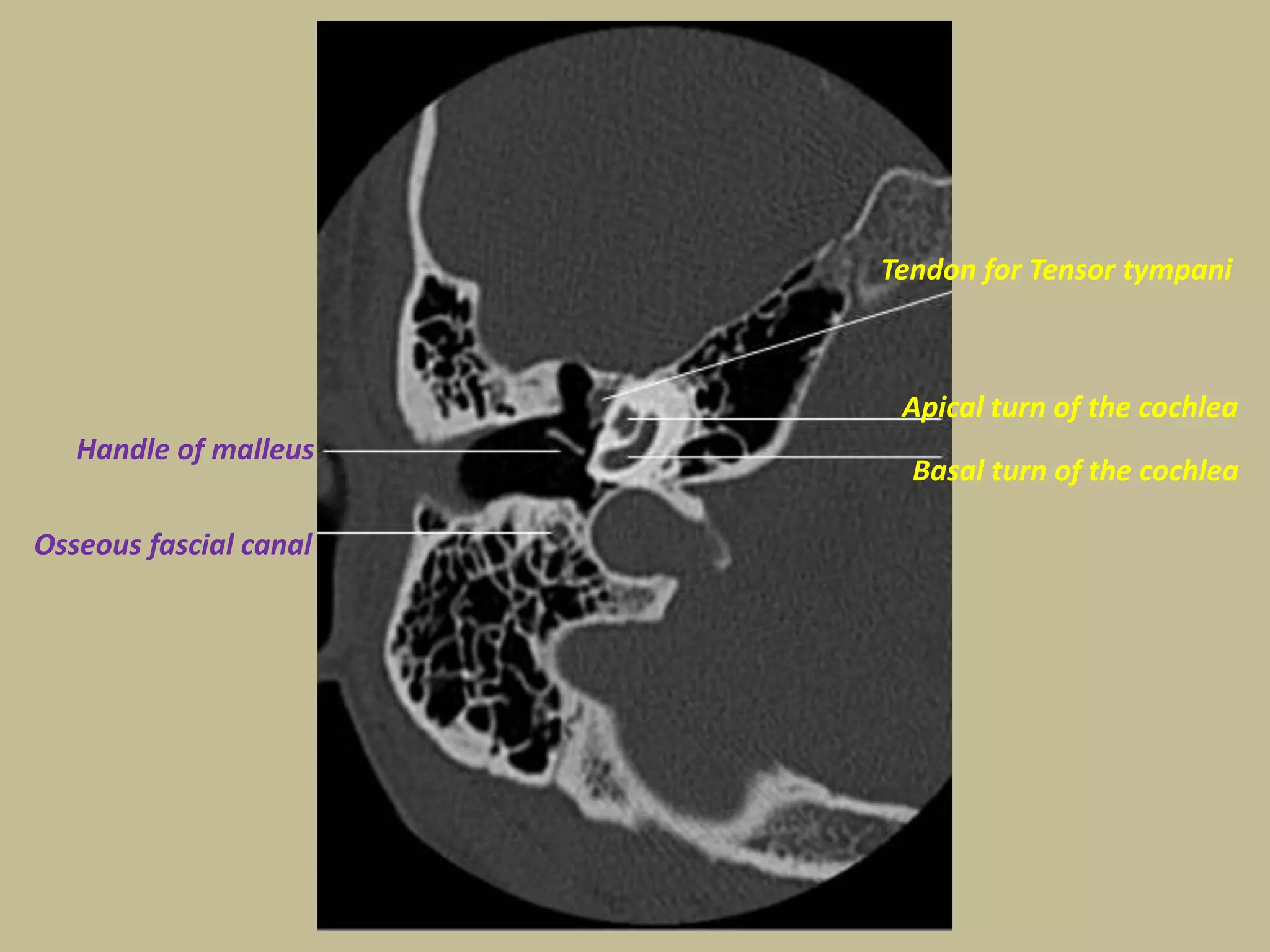 Presentation1.pptx, radiological anatomy of the petrous bone. | PPTX
