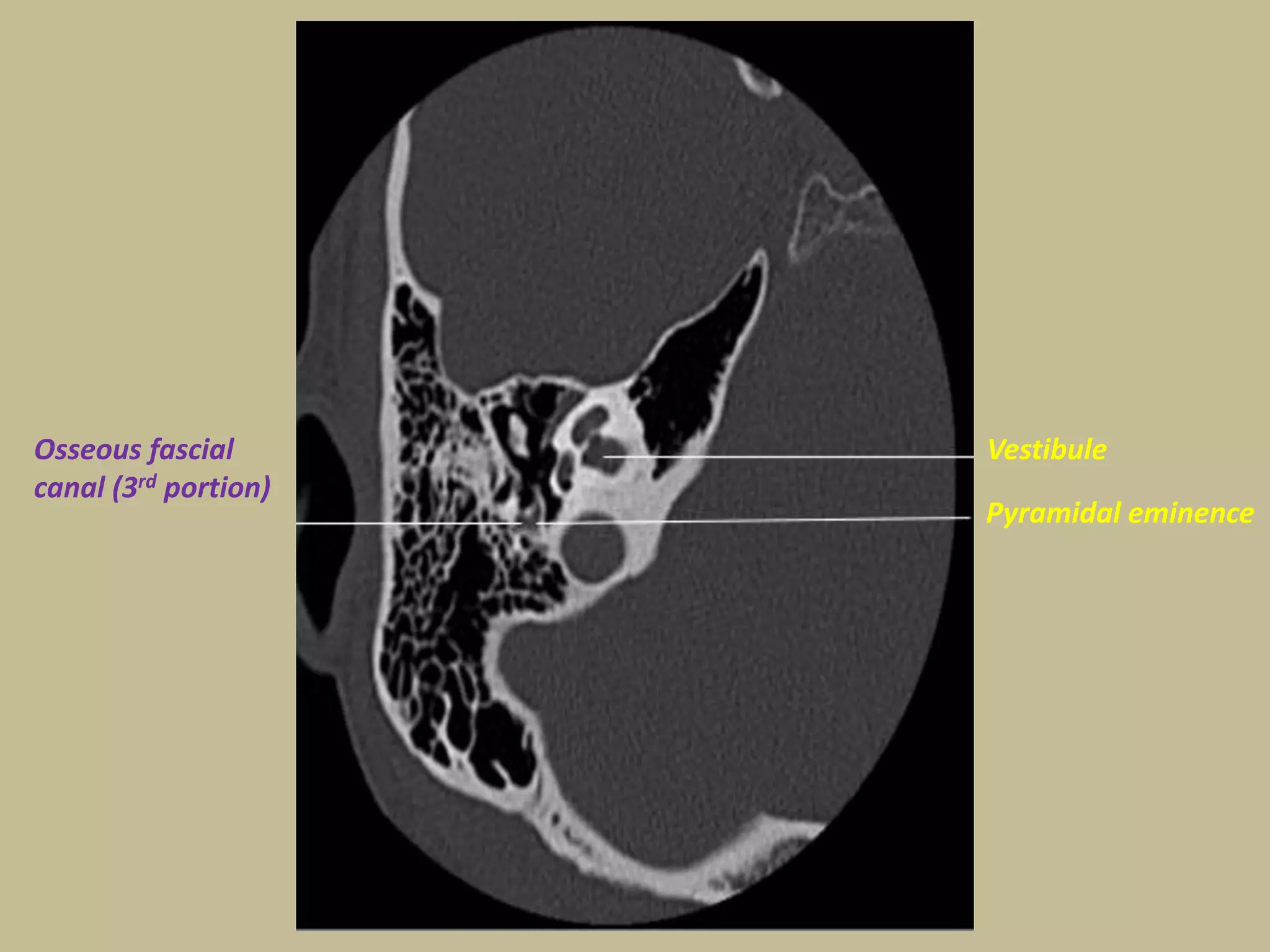 Presentation1.pptx, radiological anatomy of the petrous bone. | PPTX