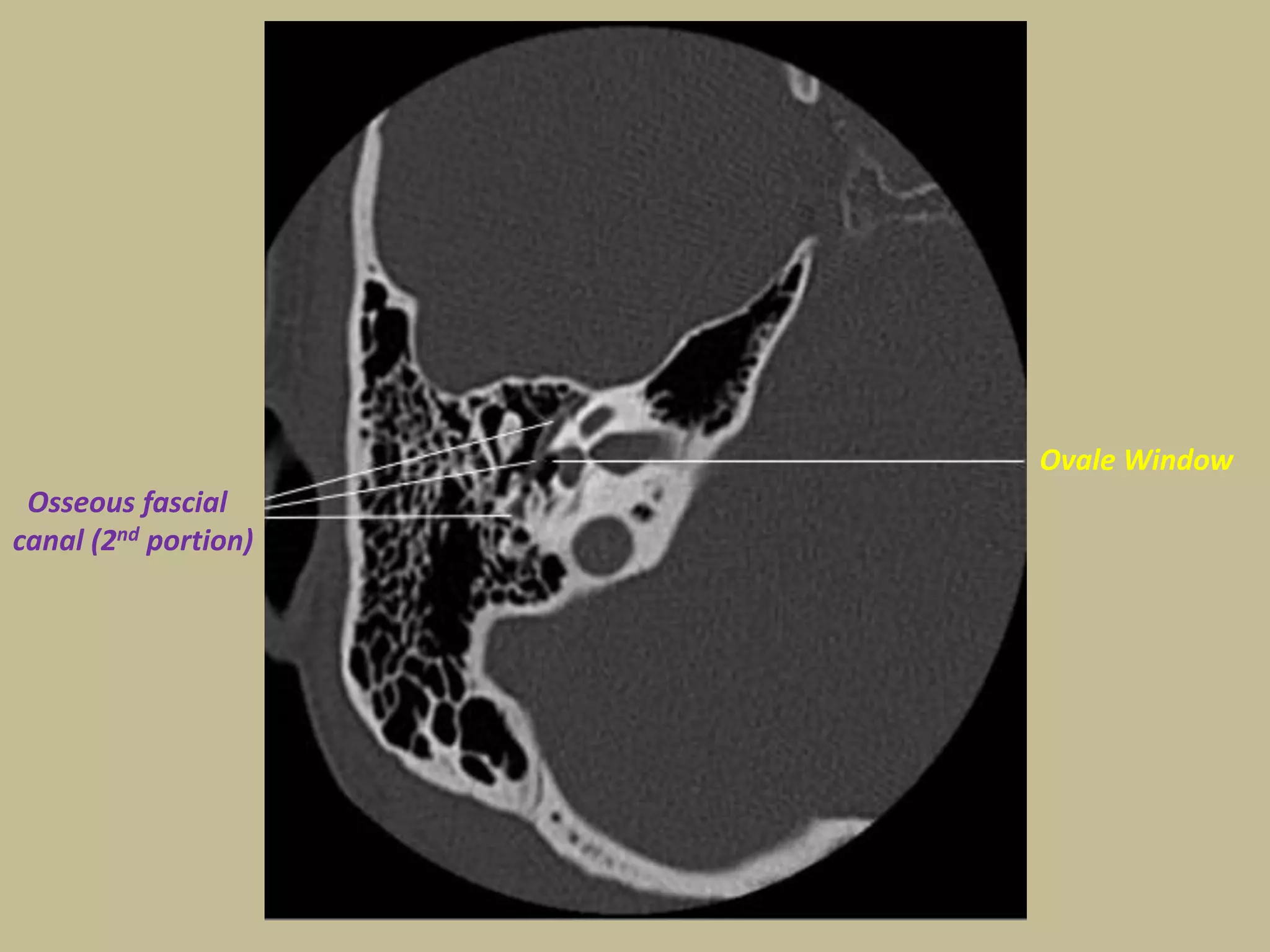 Presentation1.pptx, radiological anatomy of the petrous bone. | PPTX
