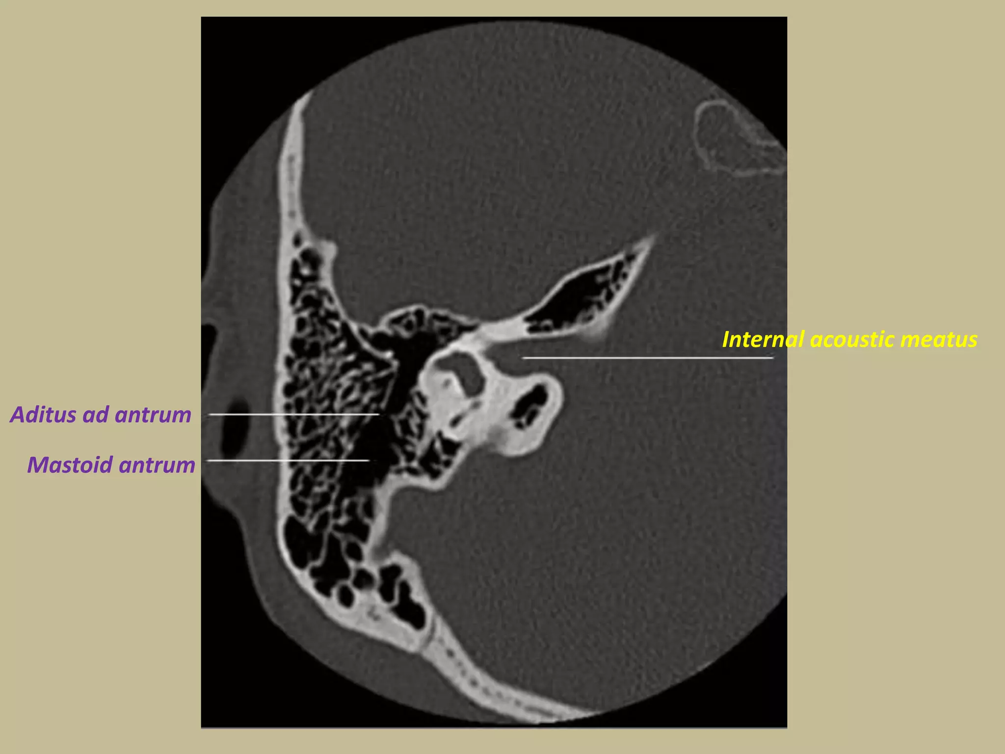 Presentation1.pptx, radiological anatomy of the petrous bone. | PPTX