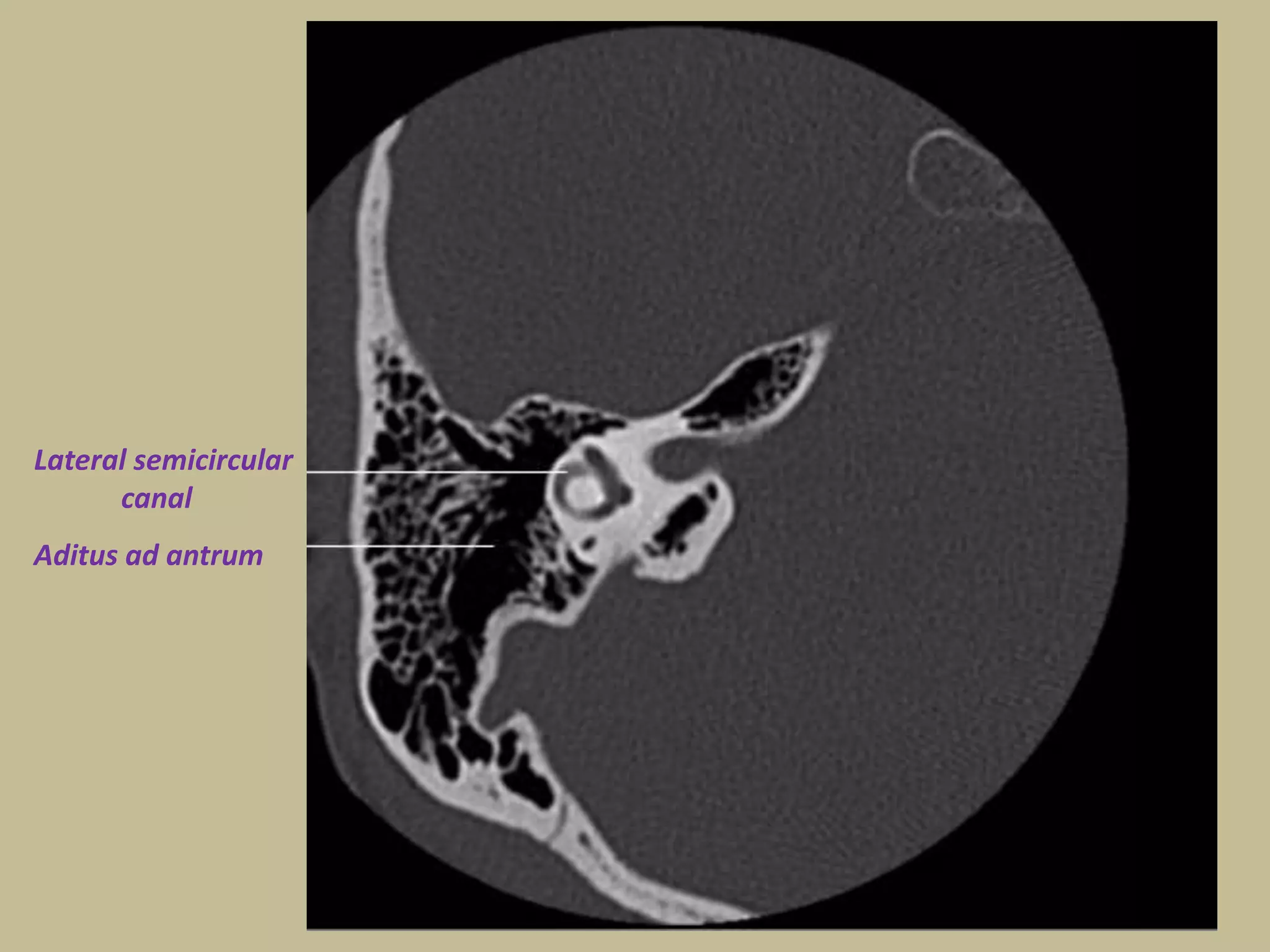 Presentation1.pptx, radiological anatomy of the petrous bone. | PPTX