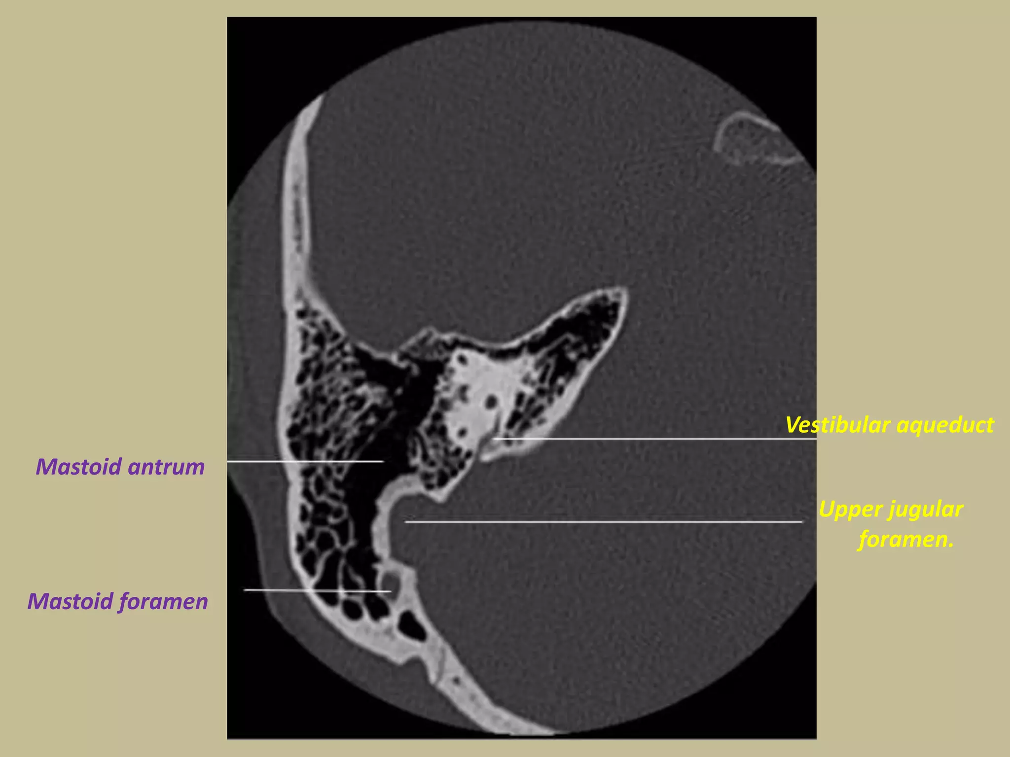 Presentation1.pptx, radiological anatomy of the petrous bone. | PPTX
