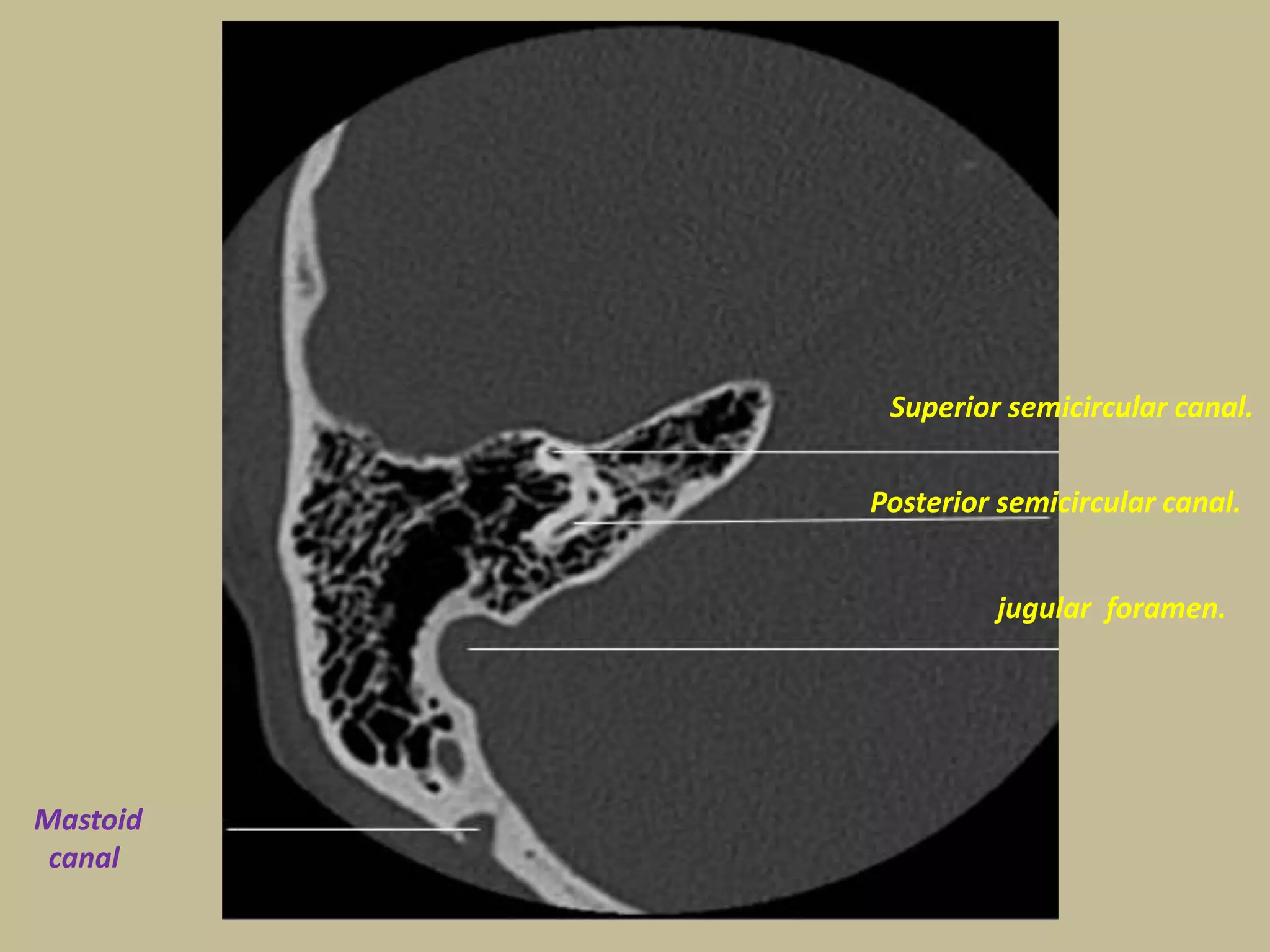 Presentation1.pptx, radiological anatomy of the petrous bone. | PPTX