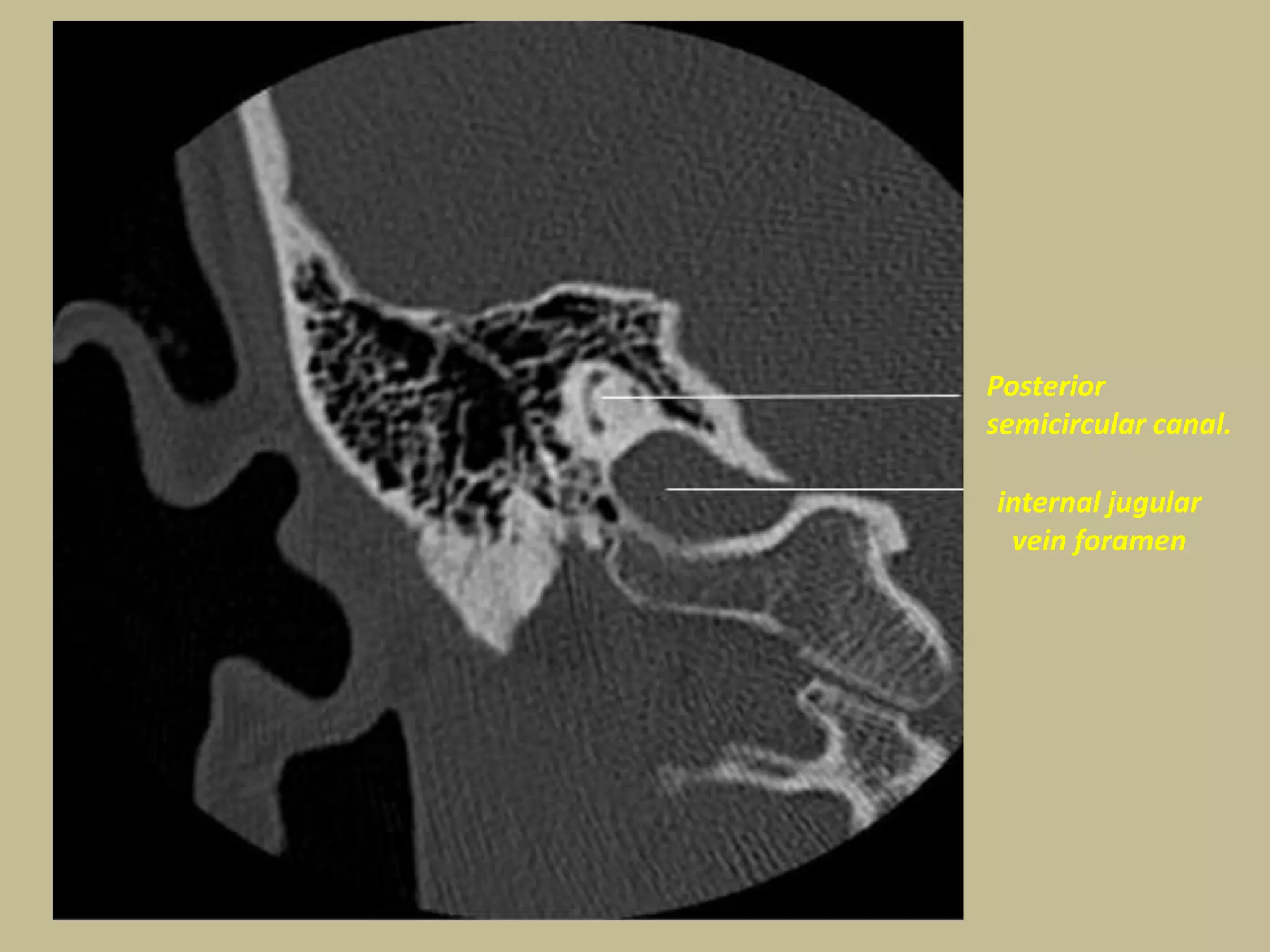 Presentation1.pptx, radiological anatomy of the petrous bone. | PPTX