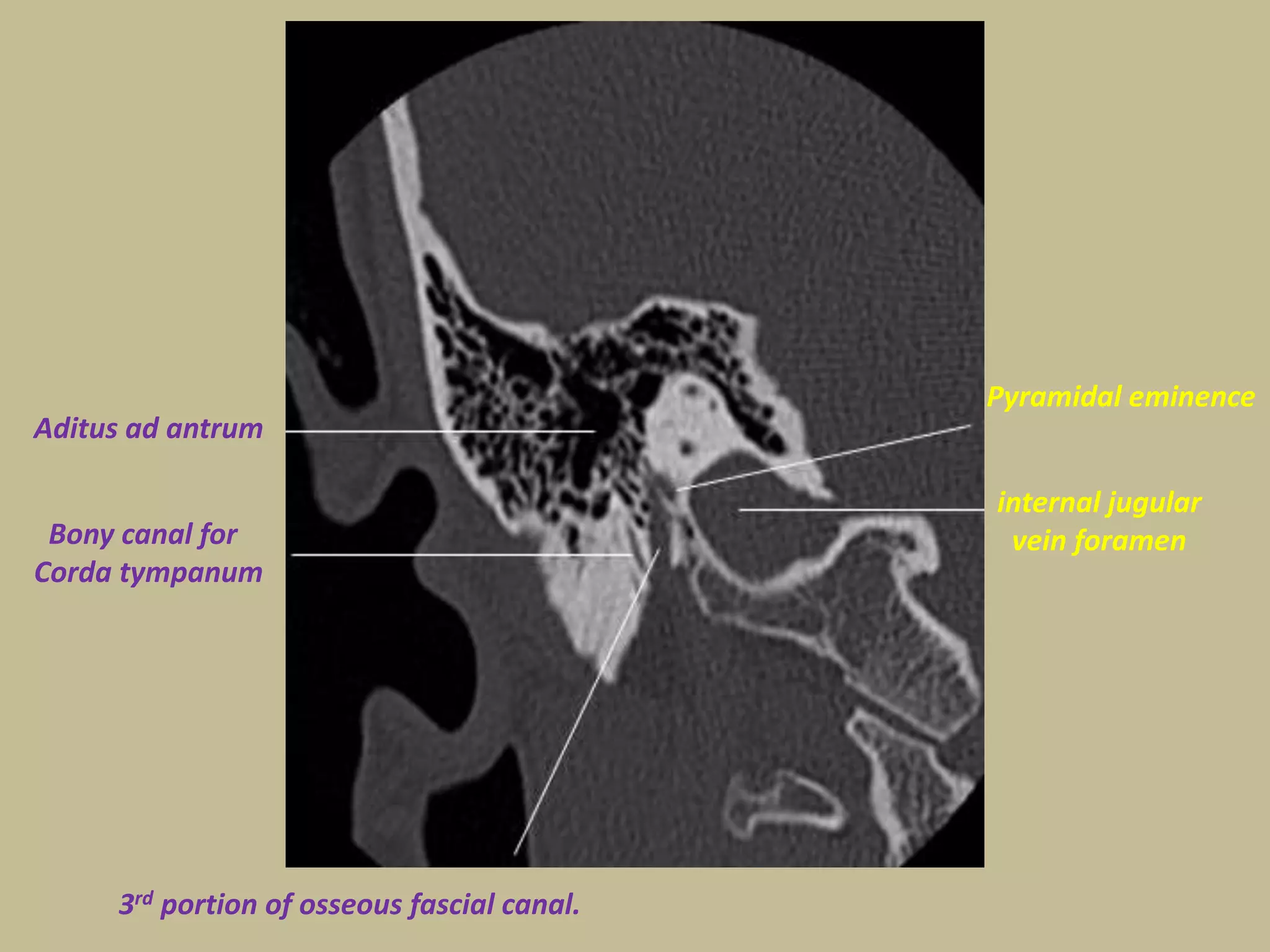 Presentation1.pptx, radiological anatomy of the petrous bone. | PPTX