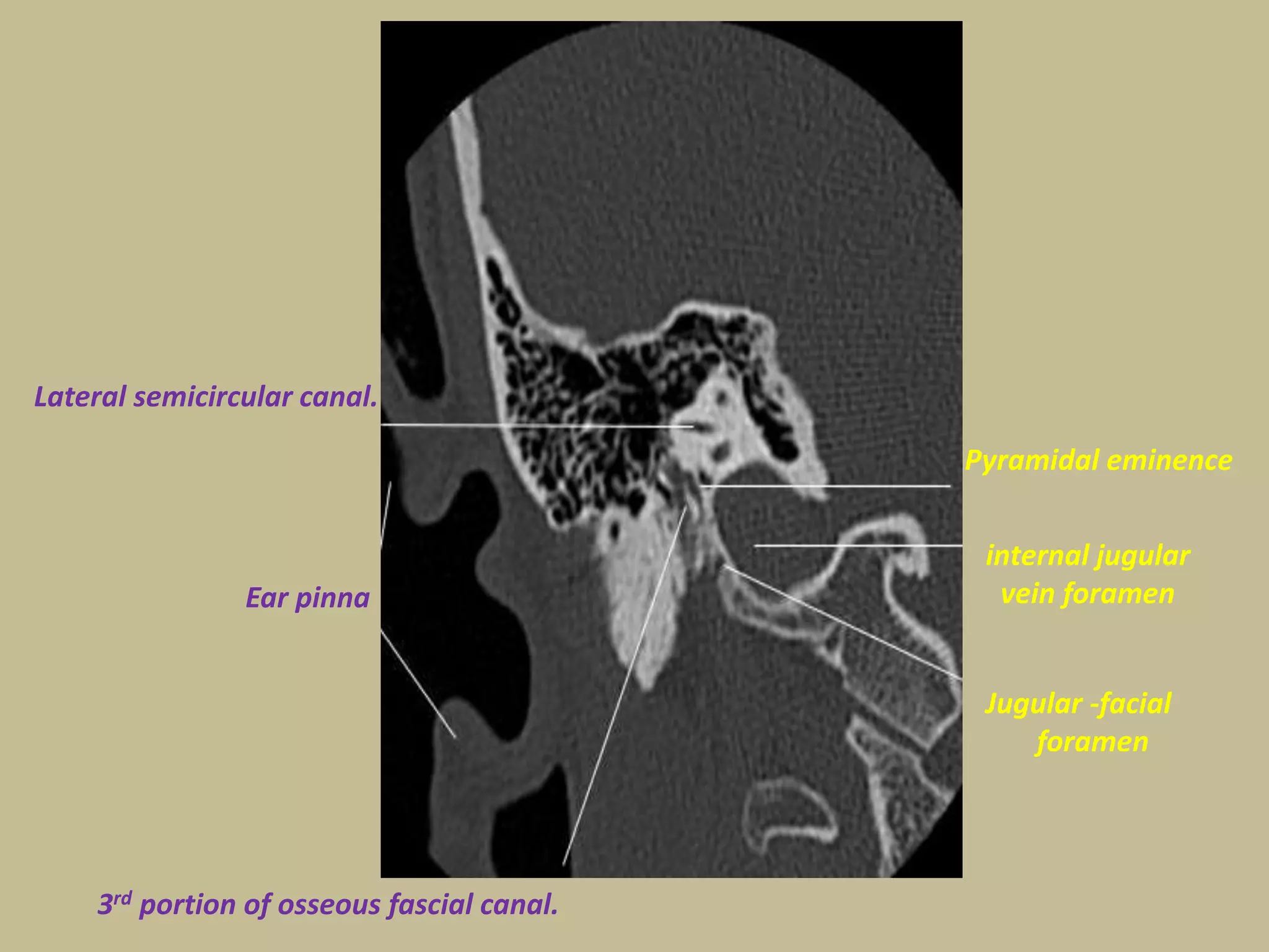 Presentation1.pptx, radiological anatomy of the petrous bone. | PPTX