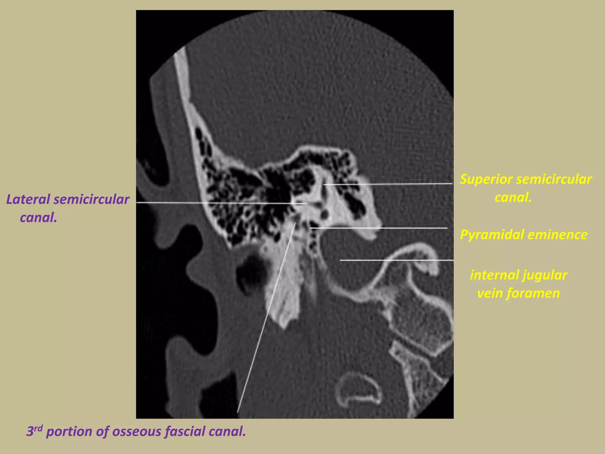 Presentation1.pptx, radiological anatomy of the petrous bone. | PPTX