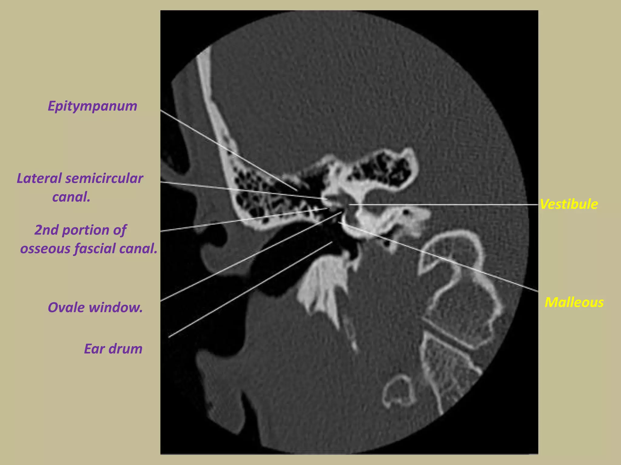 Presentation1.pptx, radiological anatomy of the petrous bone. | PPTX