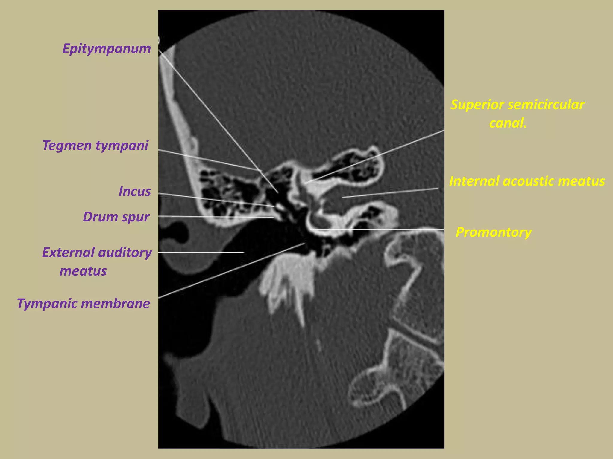 Presentation1.pptx, radiological anatomy of the petrous bone. | PPTX