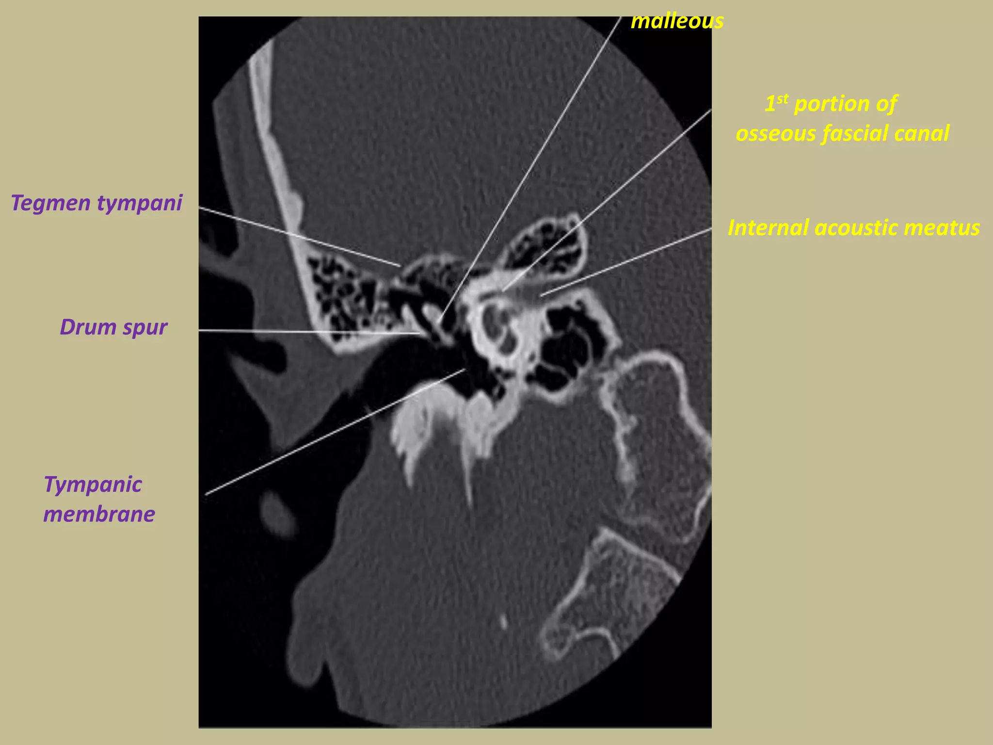 Presentation1.pptx, radiological anatomy of the petrous bone. | PPTX