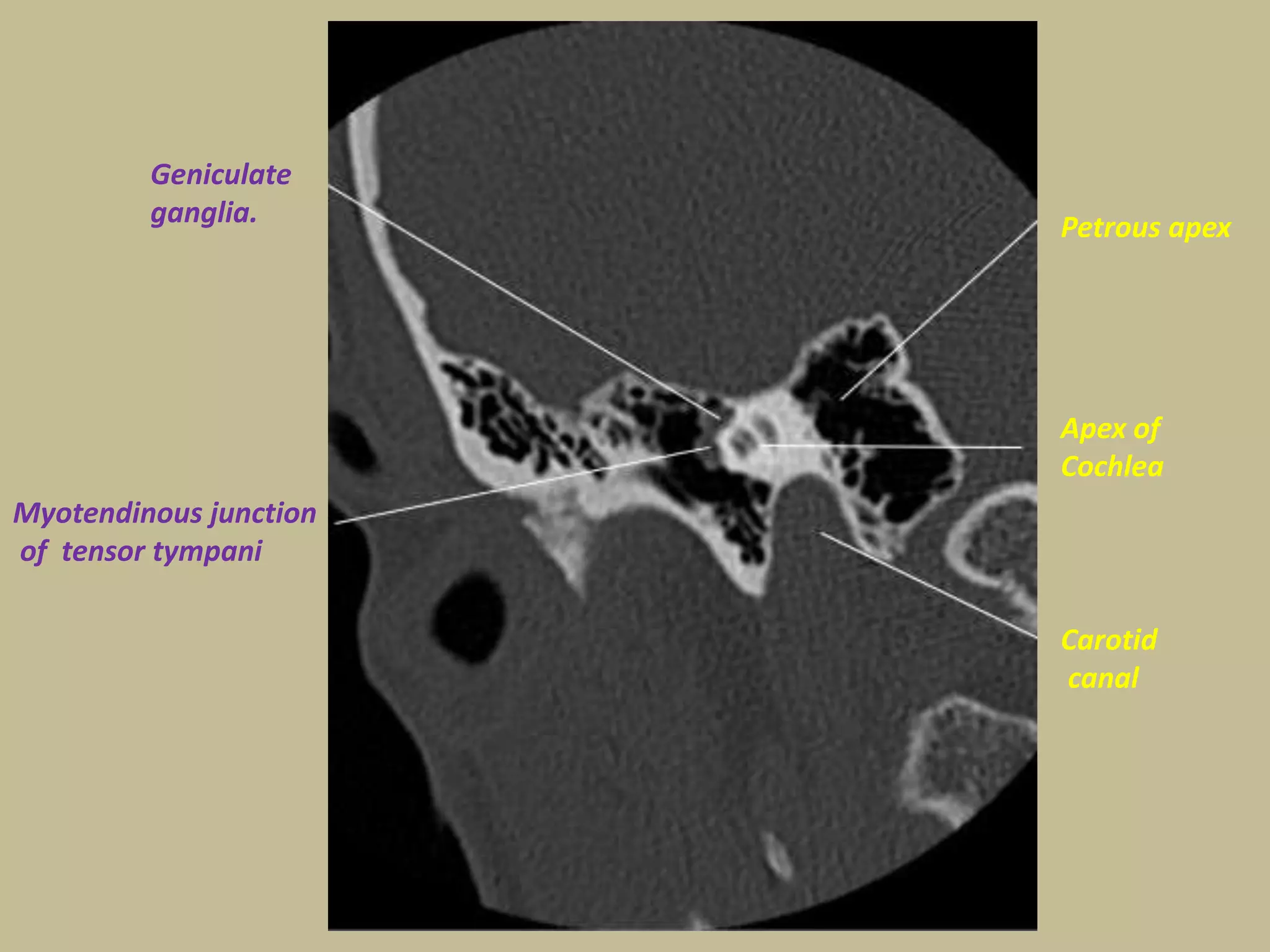 Presentation1.pptx, radiological anatomy of the petrous bone. | PPTX