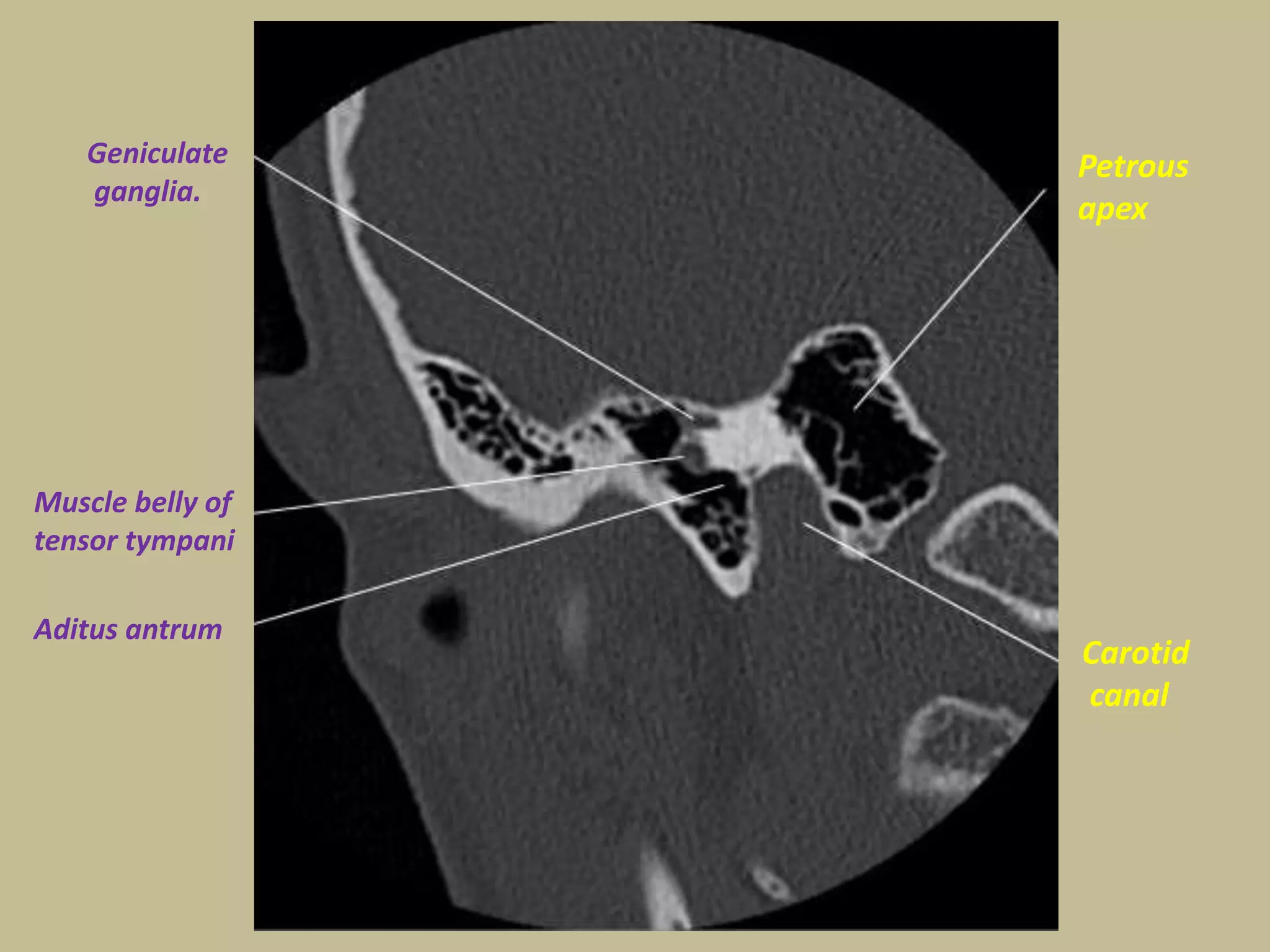 Presentation1.pptx, radiological anatomy of the petrous bone. | PPTX