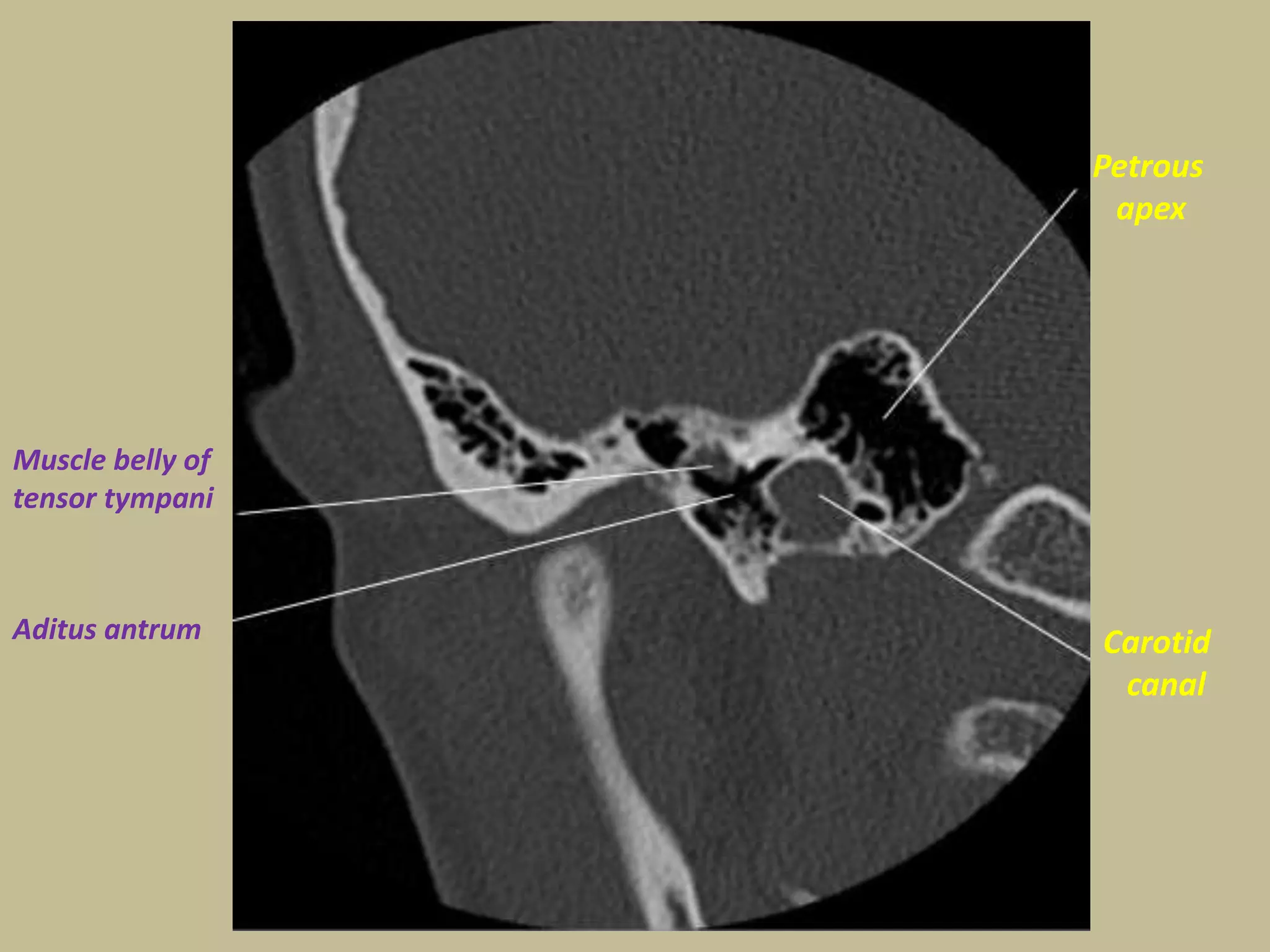 Presentation1.pptx, radiological anatomy of the petrous bone. | PPTX