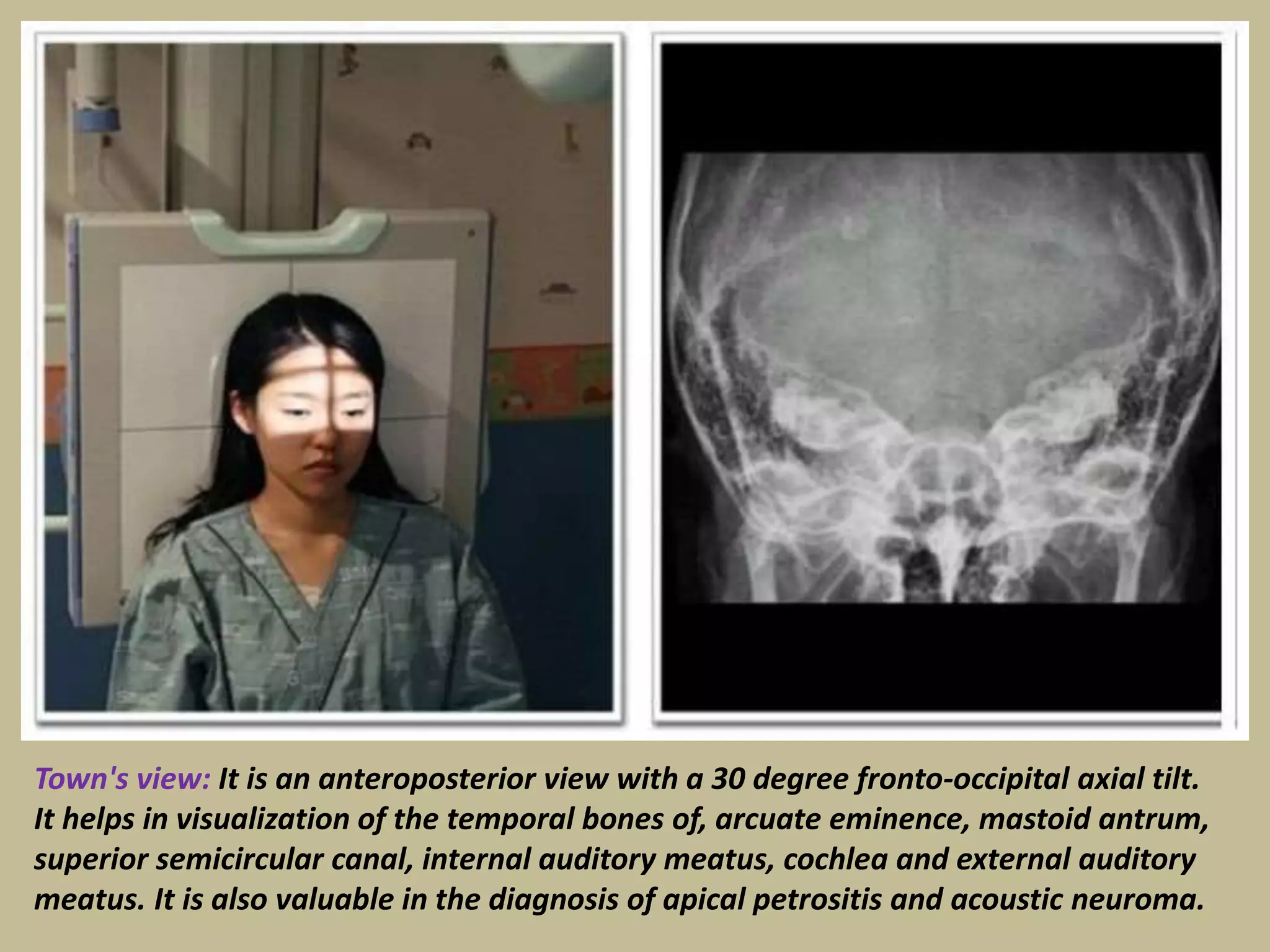 Presentation1.pptx, radiological anatomy of the petrous bone. | PPTX