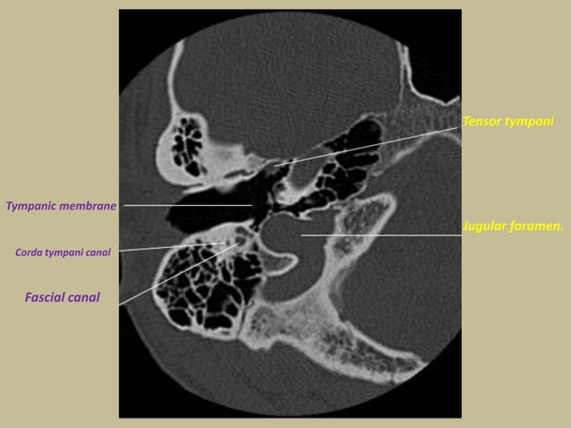 Presentation1.pptx, radiological anatomy of the petrous bone. | PPTX