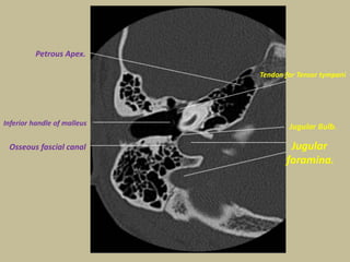 Presentation1.pptx, radiological anatomy of the petrous bone. | PPTX