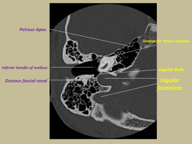 Presentation1.pptx, radiological anatomy of the petrous bone. | PPTX