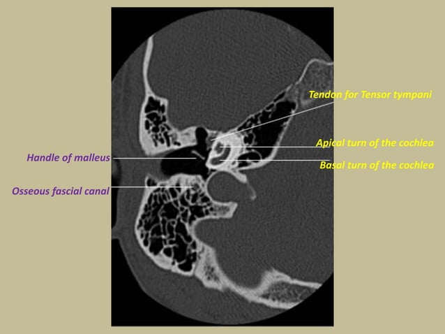 Presentation1.pptx, radiological anatomy of the petrous bone. | PPTX