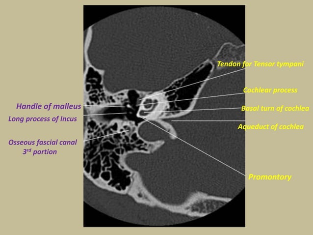 Presentation1.pptx, radiological anatomy of the petrous bone. | PPTX