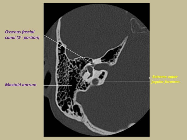 Presentation1.pptx, radiological anatomy of the petrous bone. | PPTX