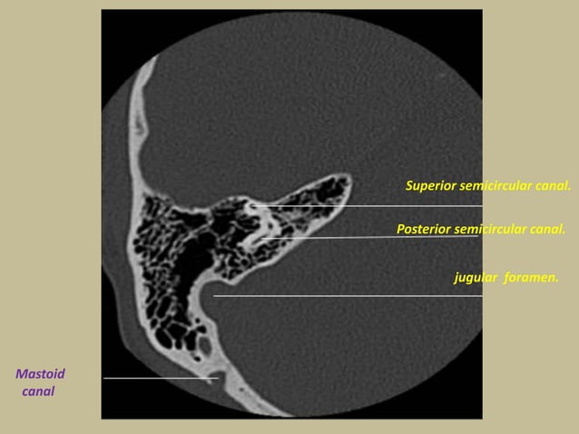 Presentation1.pptx, radiological anatomy of the petrous bone. | PPTX