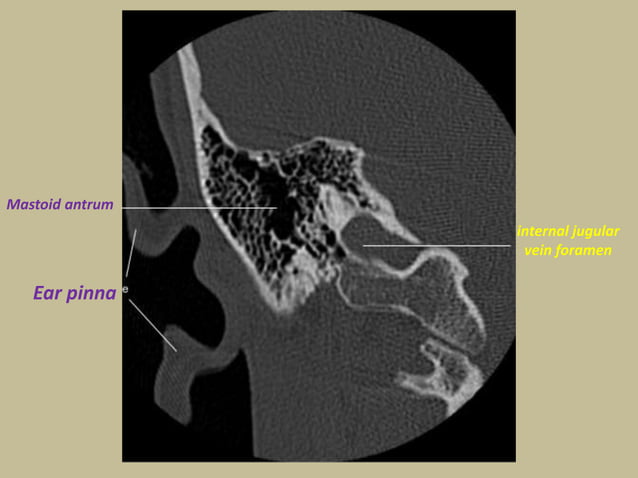 Presentation1.pptx, radiological anatomy of the petrous bone. | PPTX
