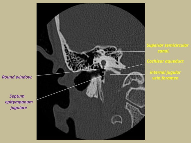 Presentation1.pptx, radiological anatomy of the petrous bone. | PPTX