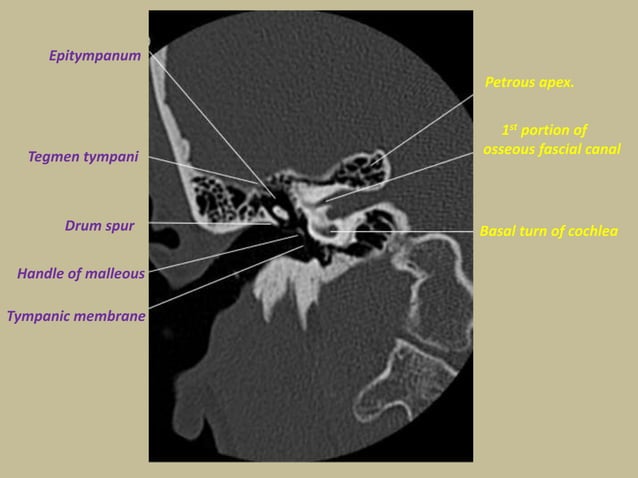 Presentation1.pptx, radiological anatomy of the petrous bone. | PPTX