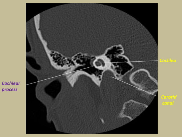 Presentation1.pptx, radiological anatomy of the petrous bone. | PPTX