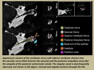 Presentation1.pptx, radiological anatomy of the petrous bone. | PPTX