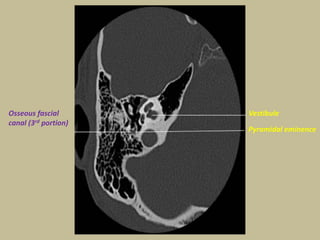 Pyramidal Eminence Ct