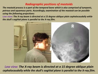 Presentation1.pptx, radiological anatomy of the petrous bone. | PPT
