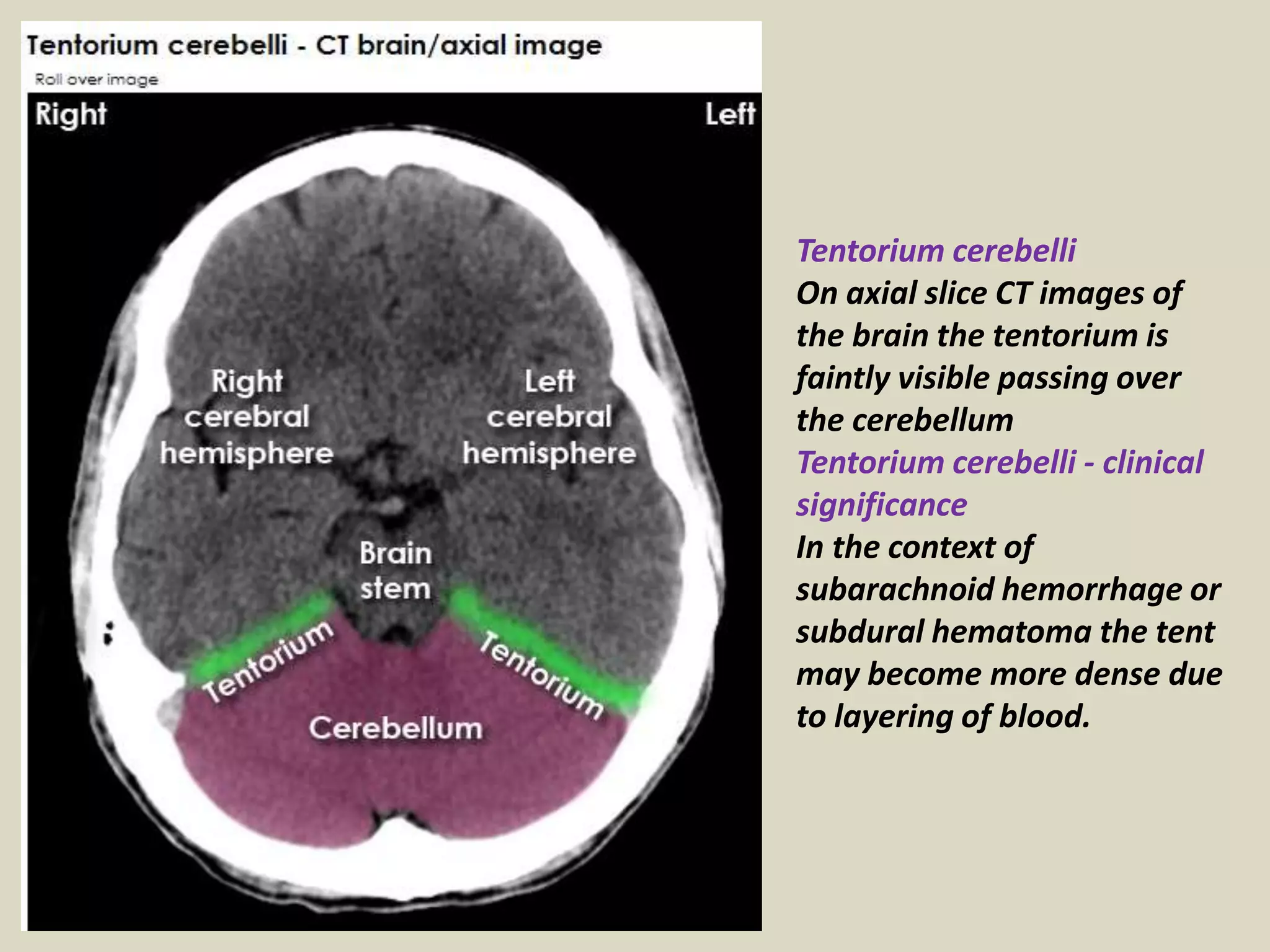 Presentation1.pptx, radiological anatomy of the brain. | PPTX