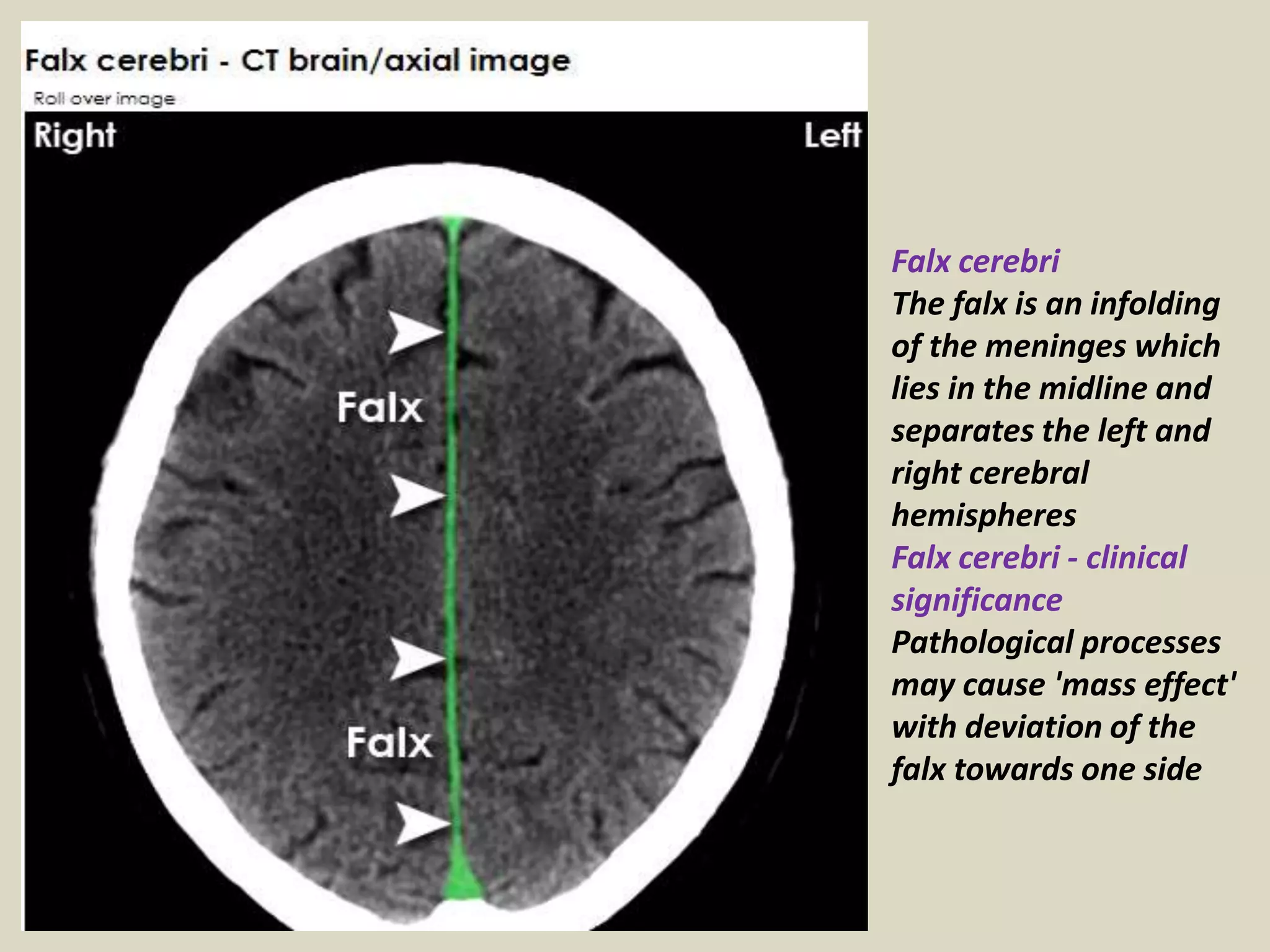 Presentation1.pptx, radiological anatomy of the brain. | PPTX