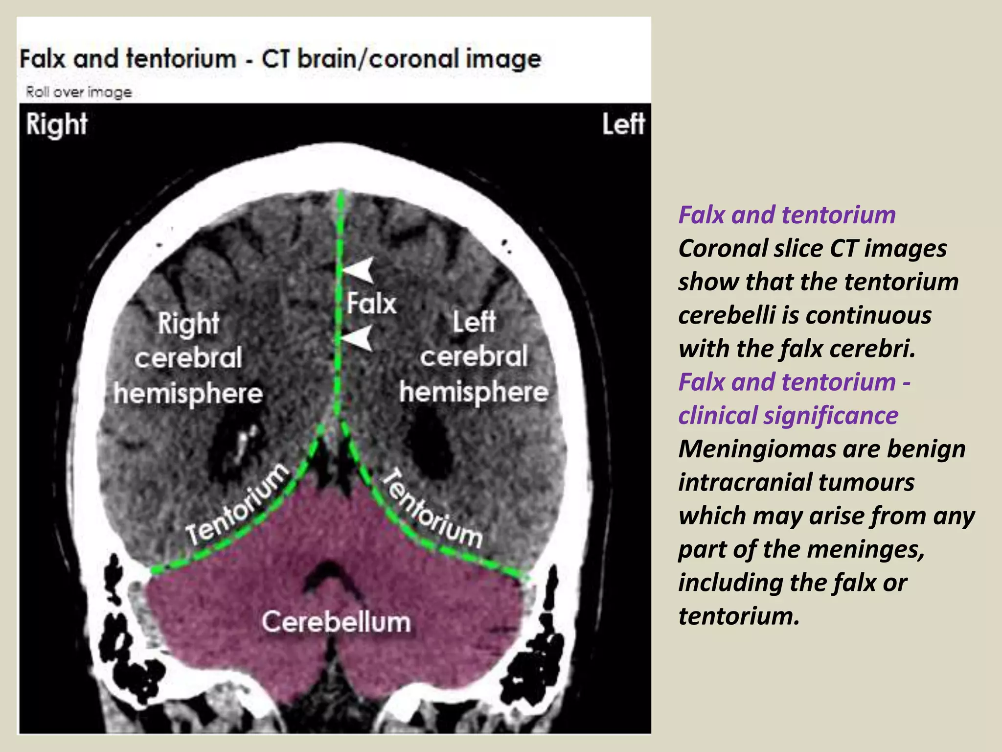 Presentation1.pptx, radiological anatomy of the brain. | PPTX