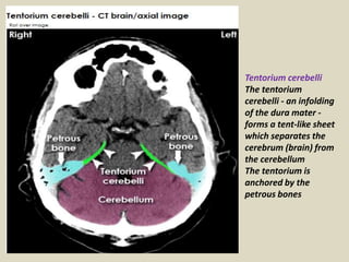 Presentation1.pptx, radiological anatomy of the brain. | PPTX