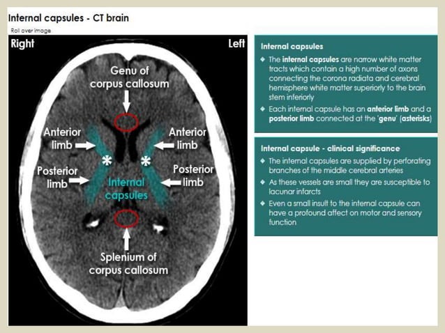 Presentation1.pptx, radiological anatomy of the brain. | PPTX | Brain ...
