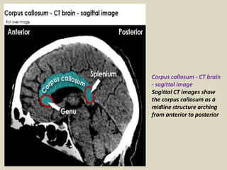 Presentation1.pptx, radiological anatomy of the brain. | PPTX