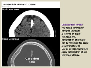 Presentation1.pptx, radiological anatomy of the brain. | PPTX