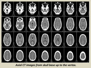 Presentation1.pptx, radiological anatomy of the brain. | PPTX