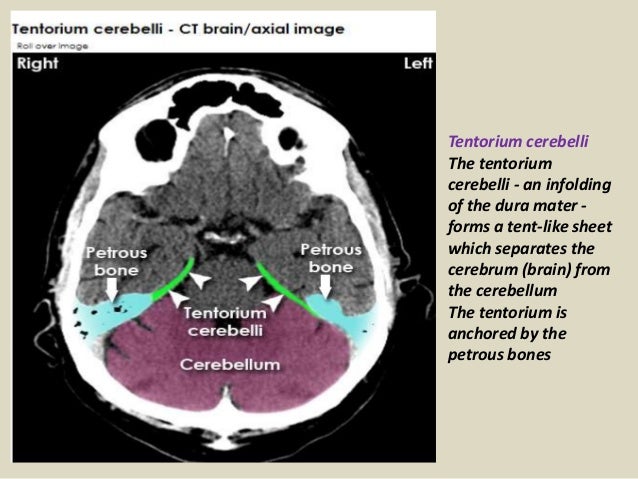 Presentation1.pptx, radiological anatomy of the brain.