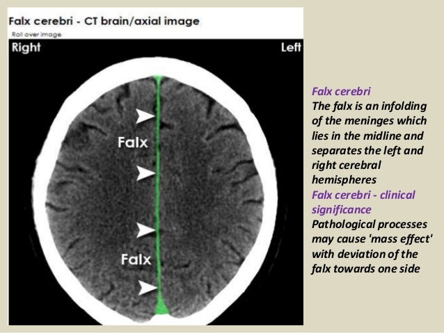 Presentation1.pptx, radiological anatomy of the brain.