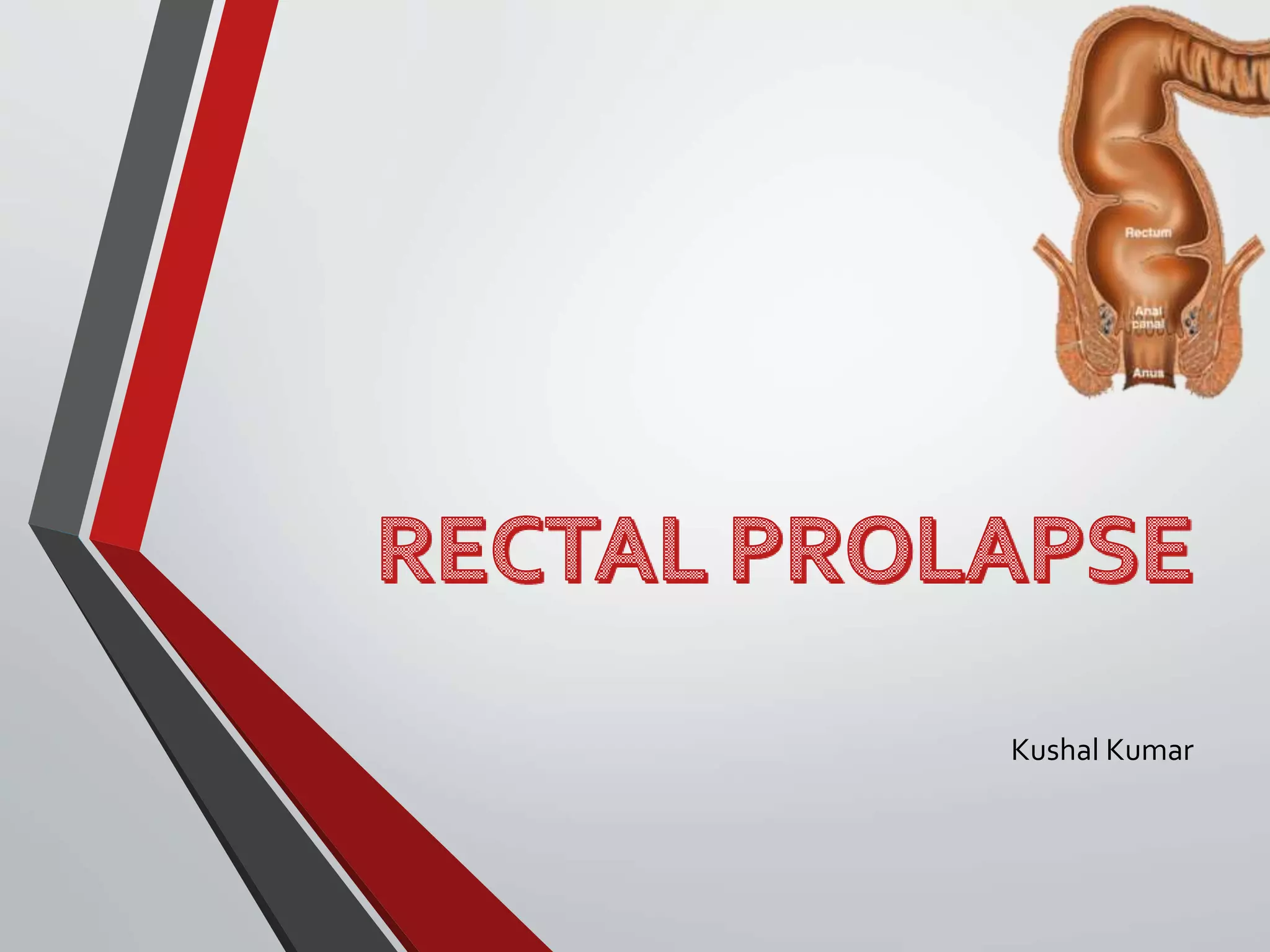 RECTAL PROLAPSE | PPTX