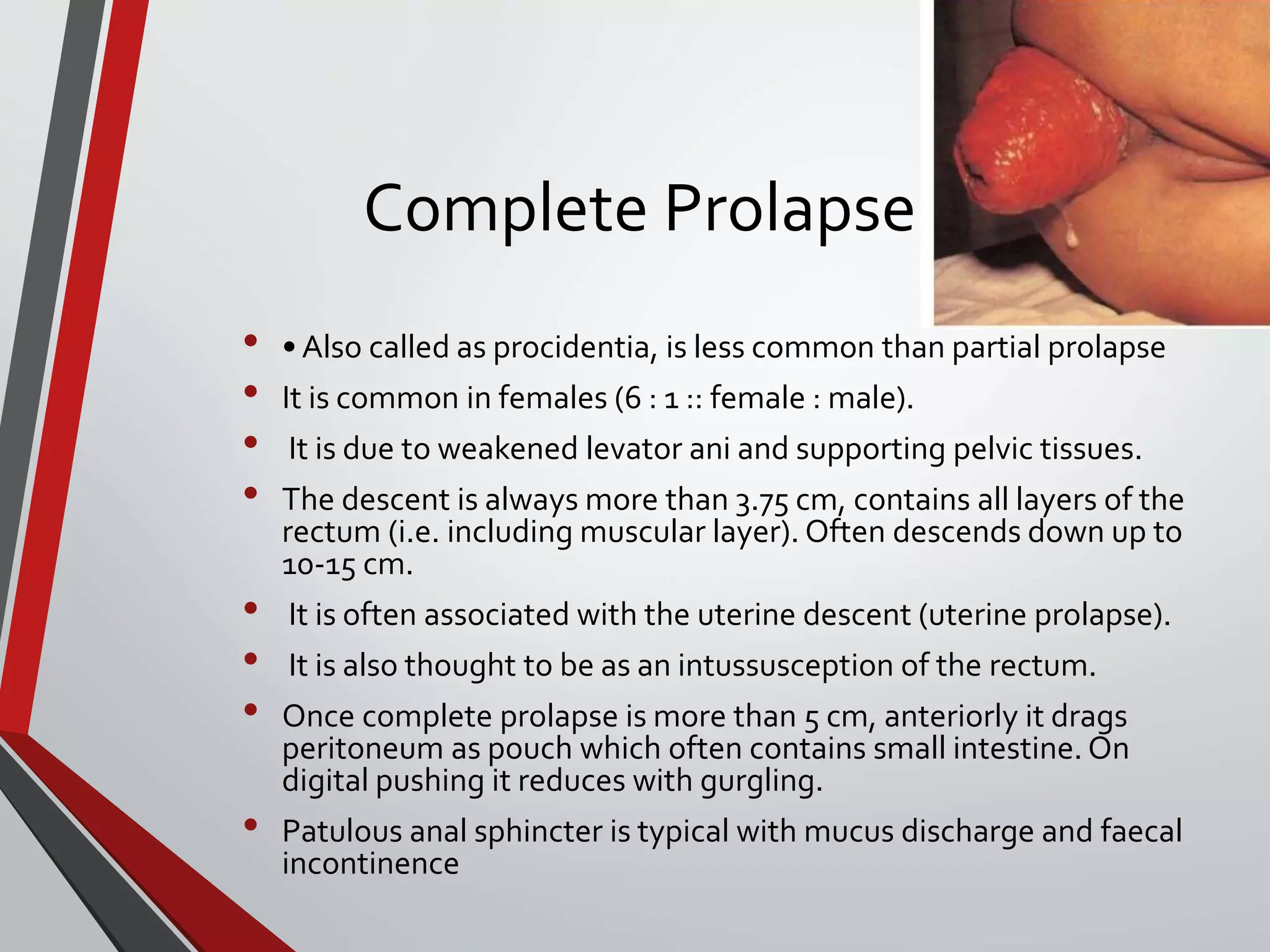 RECTAL PROLAPSE | PPTX