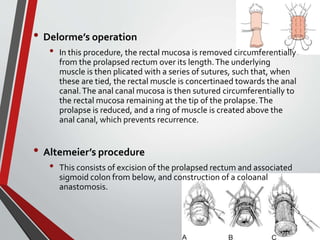 RECTAL PROLAPSE | PPTX