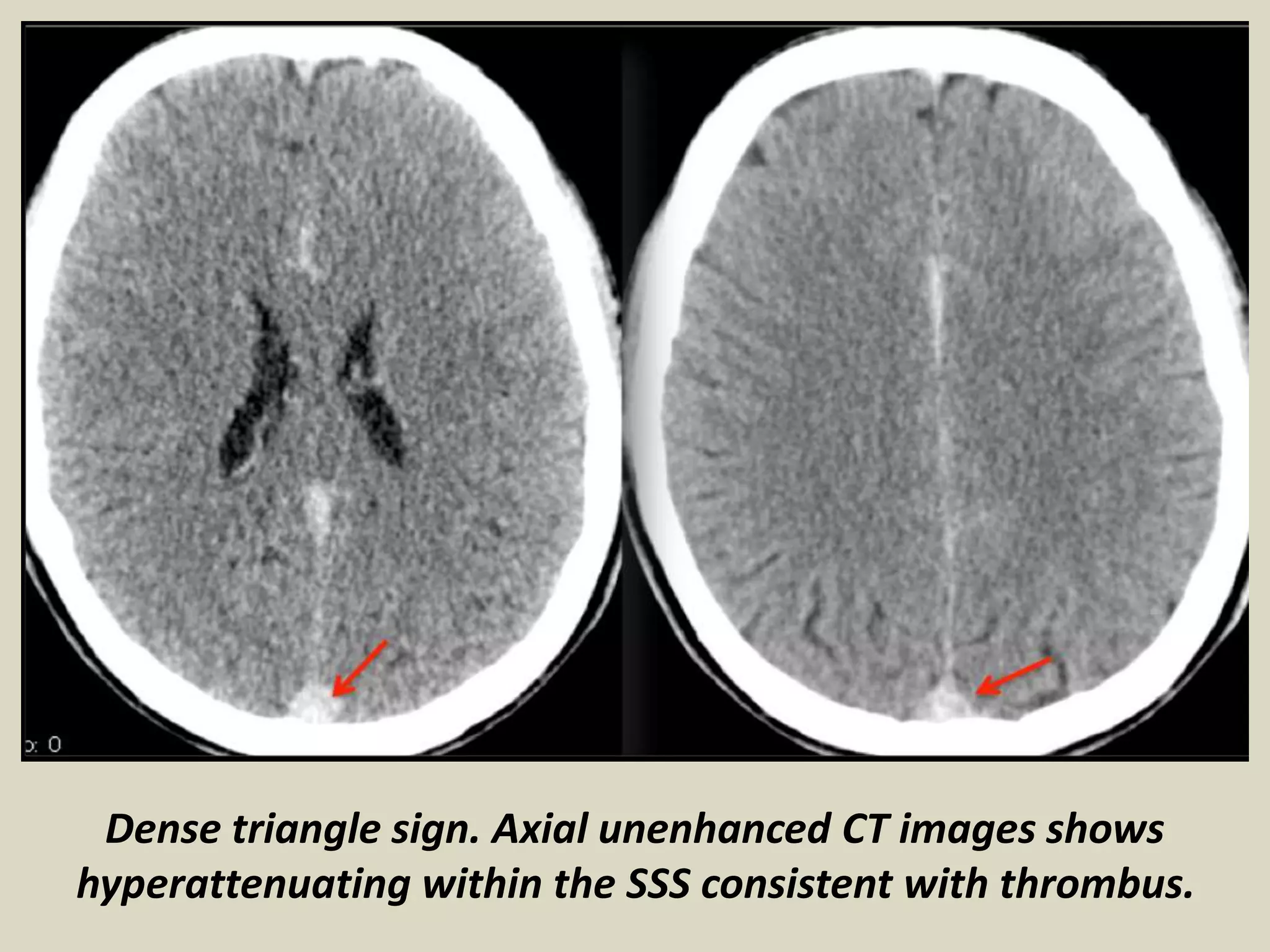 Presentation1.pptx, radiological imaging of cerebral venous thrombosis ...