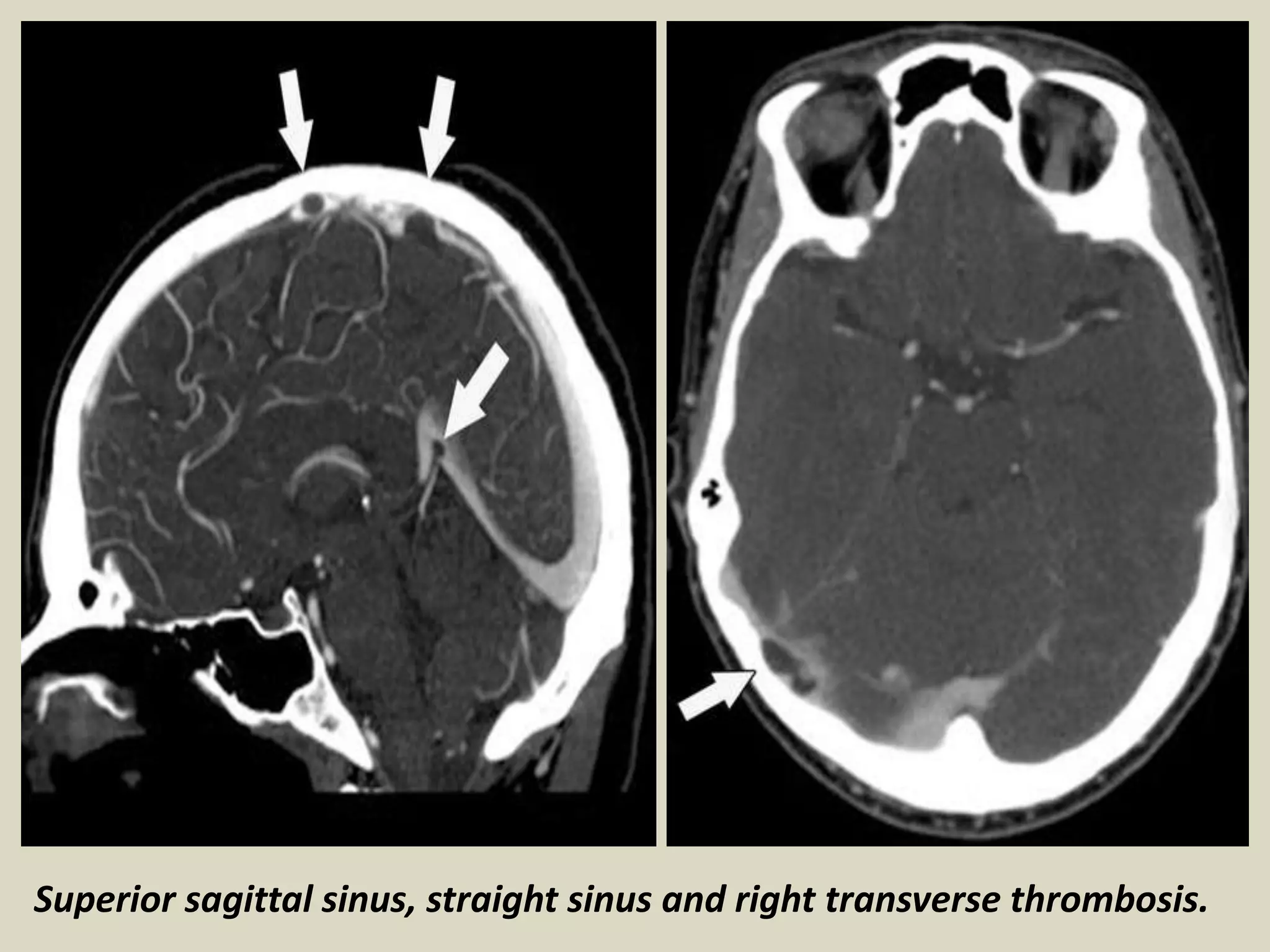 Presentation1.pptx, radiological imaging of cerebral venous thrombosis ...