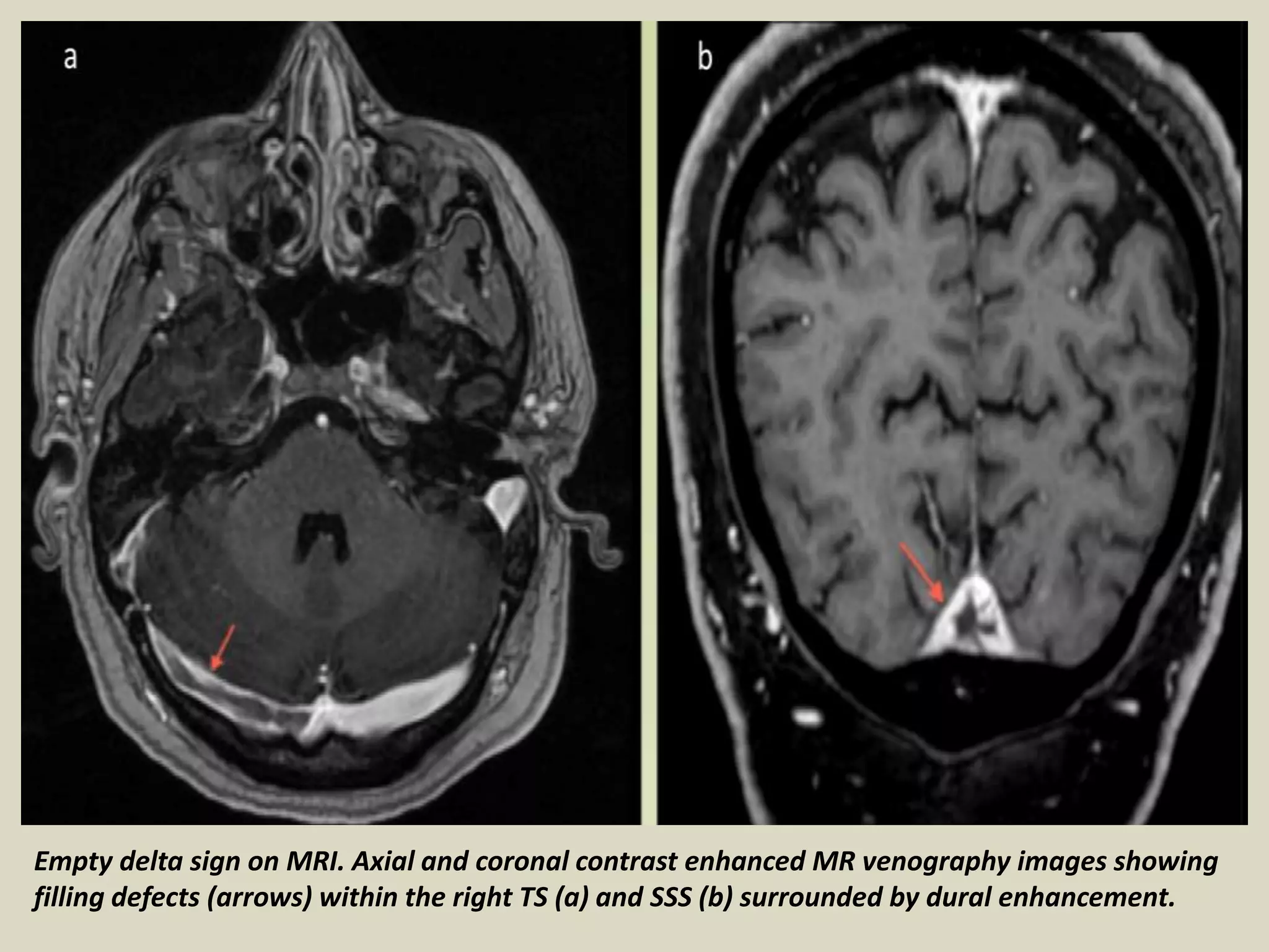 Presentation1.pptx, radiological imaging of cerebral venous thrombosis ...